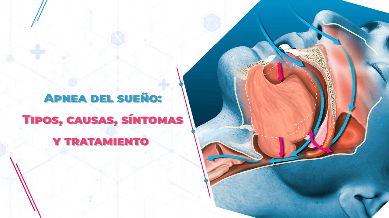 Apnea del Sueño: Tipos, Causas, Síntomas y Tratamiento