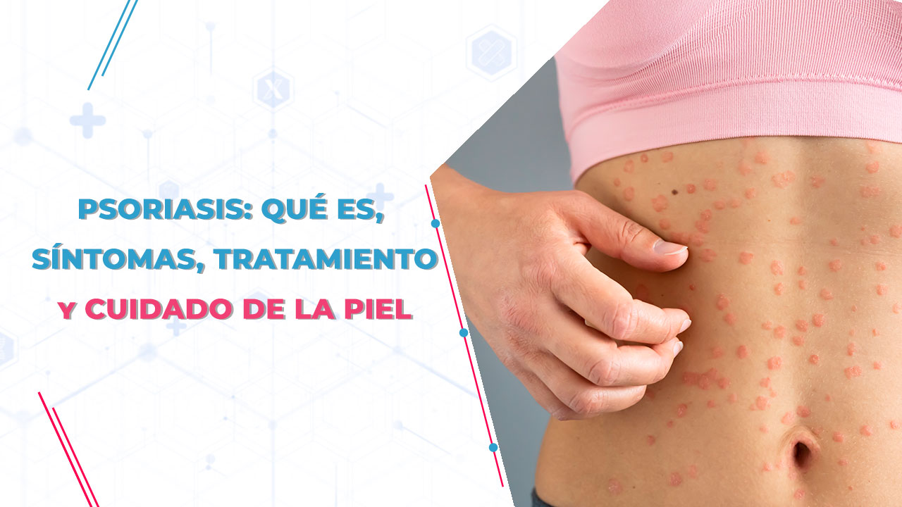 Psoriasis: Qué es, síntomas, tratamiento y consejos para el cuidado de ...