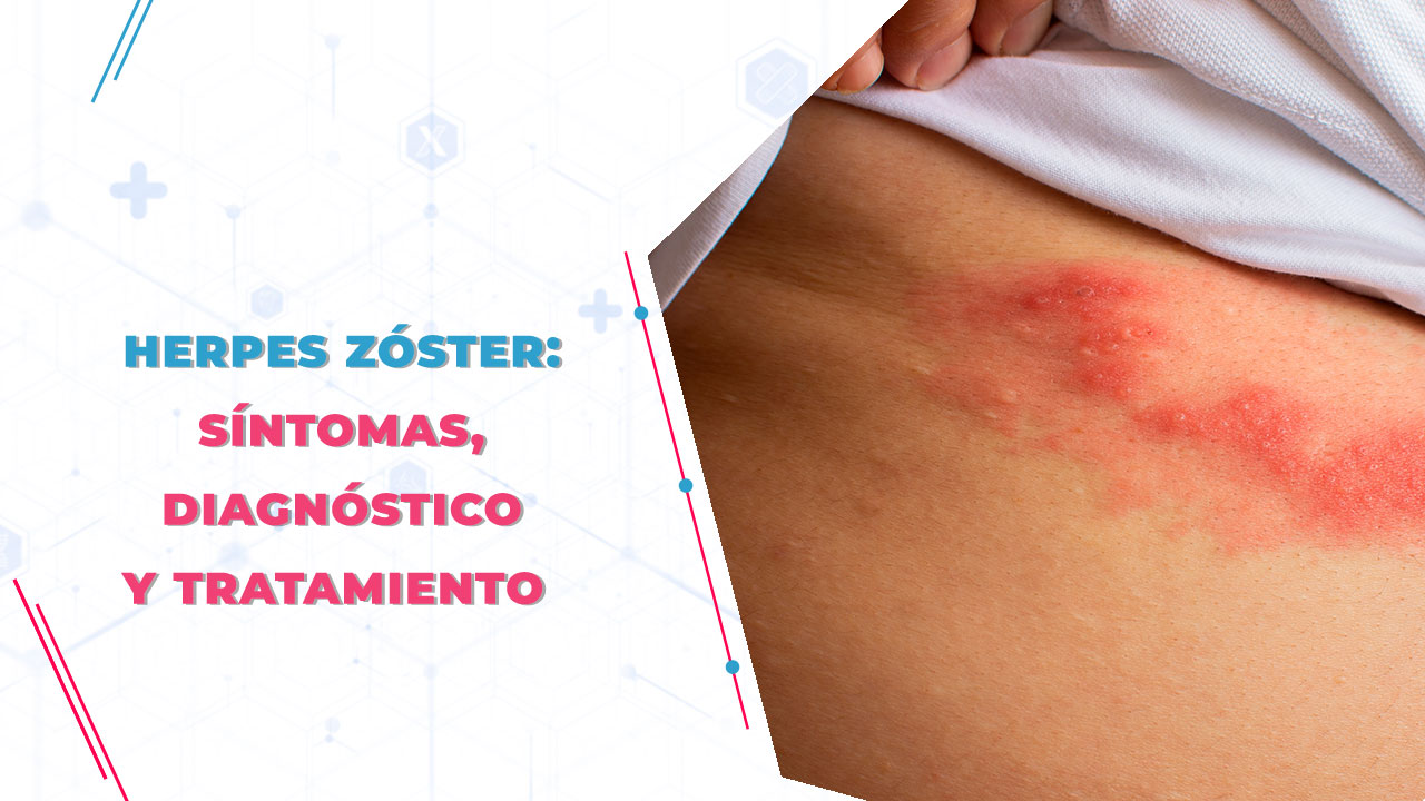 Herpes Zóster: Síntomas, diagnóstico y tratamiento