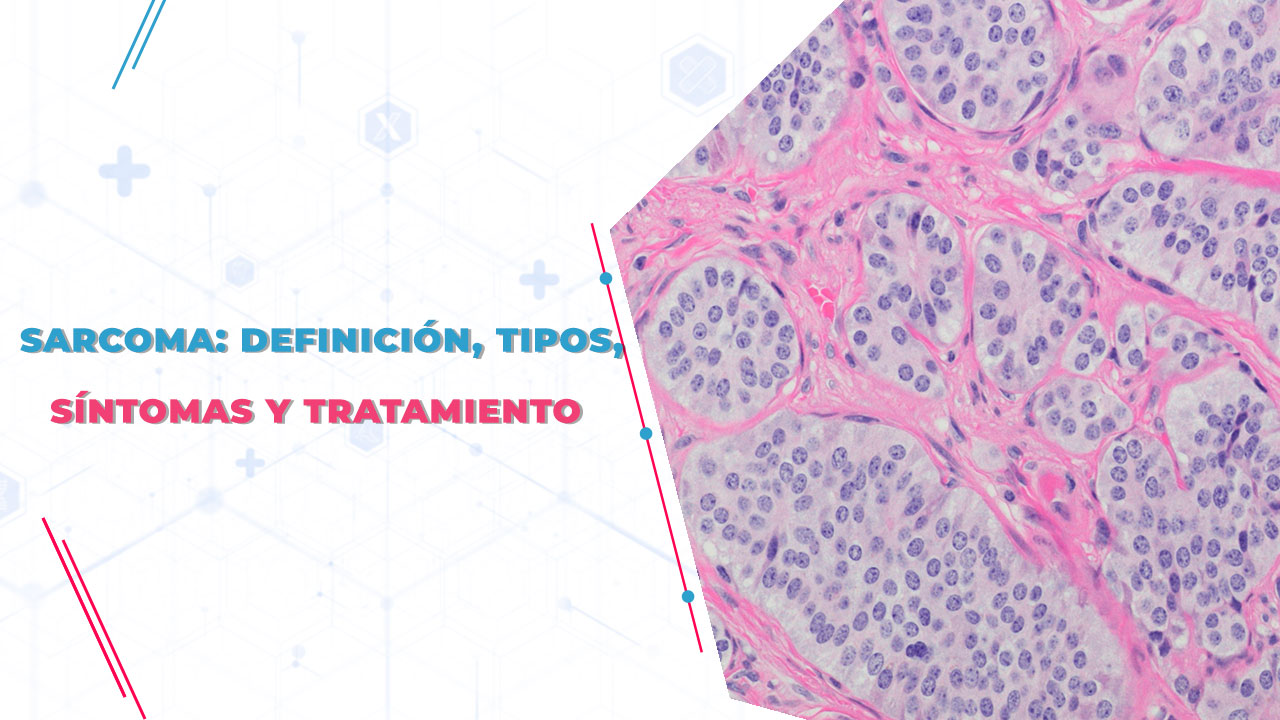 Sarcoma: Definición, tipos, síntomas y tratamiento